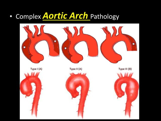 Complex Aortic Arch Surgery | PPTX | Heart and Cardiovascular Diseases ...