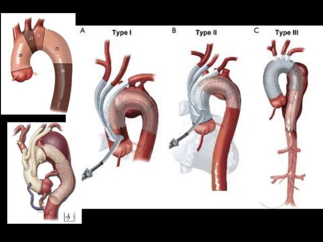 Complex Aortic Arch Surgery