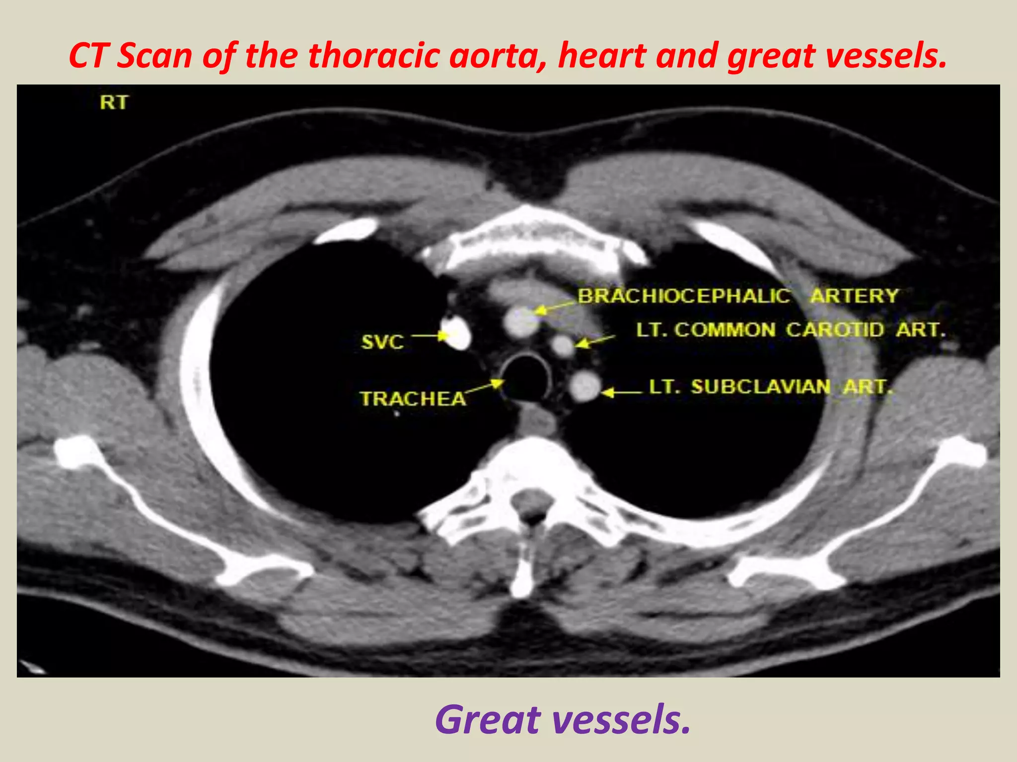 Presentation1.pptx, radiological vascular anatomy of the chest and ...