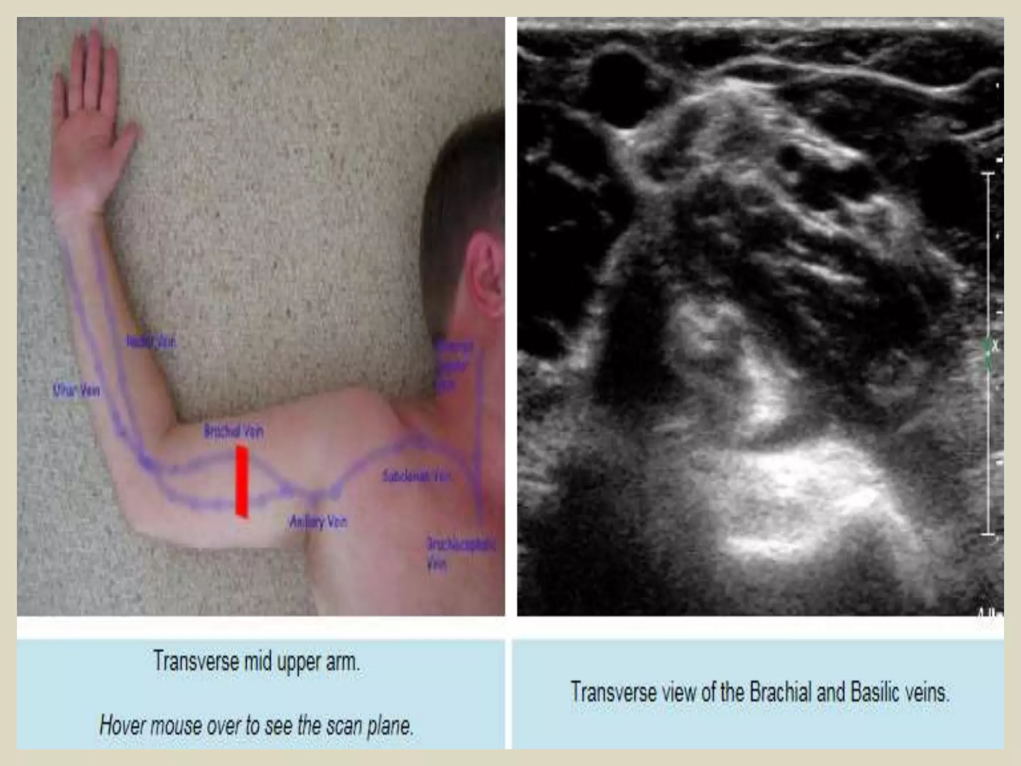 Presentation1.pptx, radiological vascular anatomy of the upper and lower limbs. | PPTX