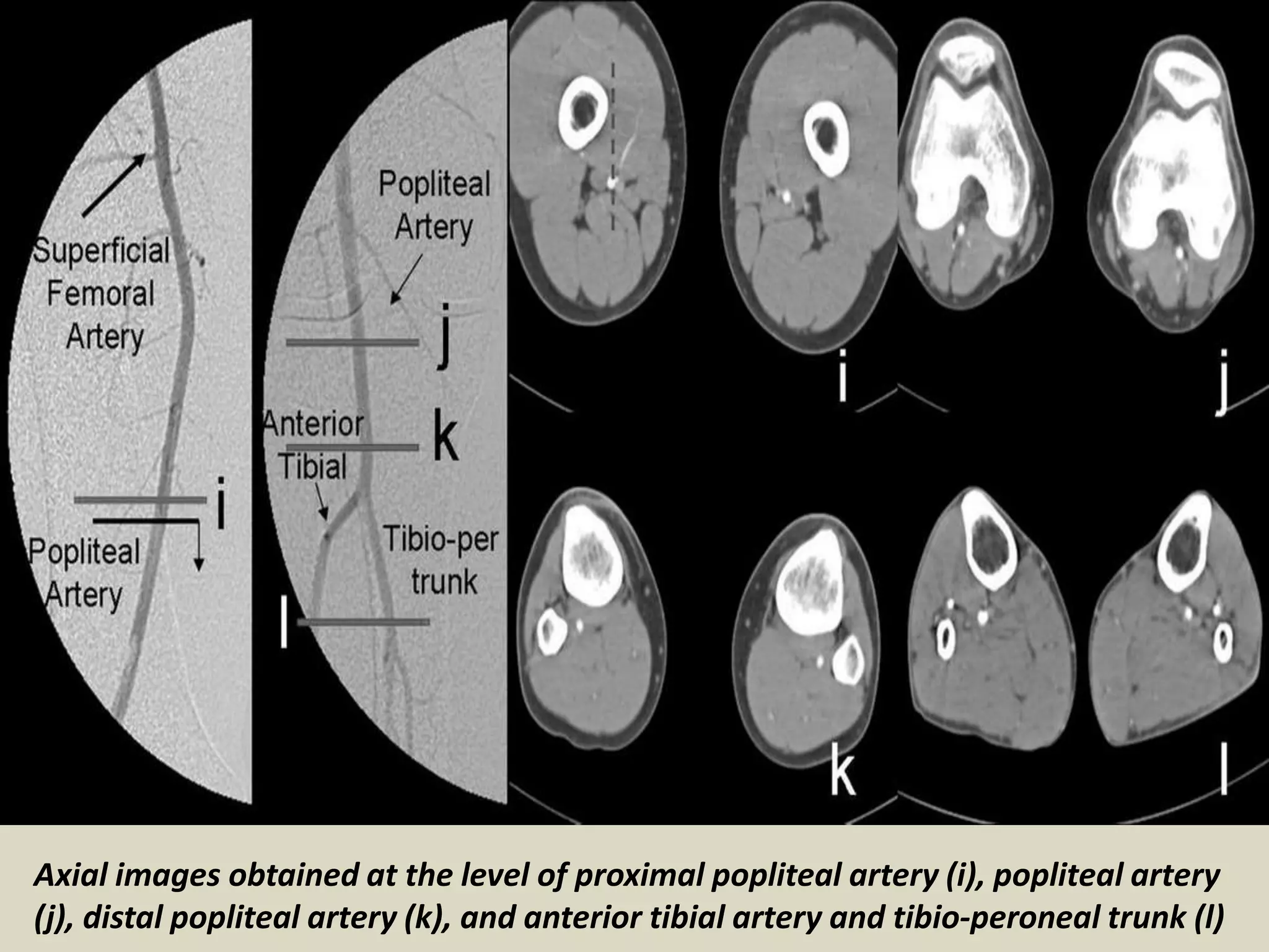 Presentation1.pptx, radiological vascular anatomy of the upper and ...