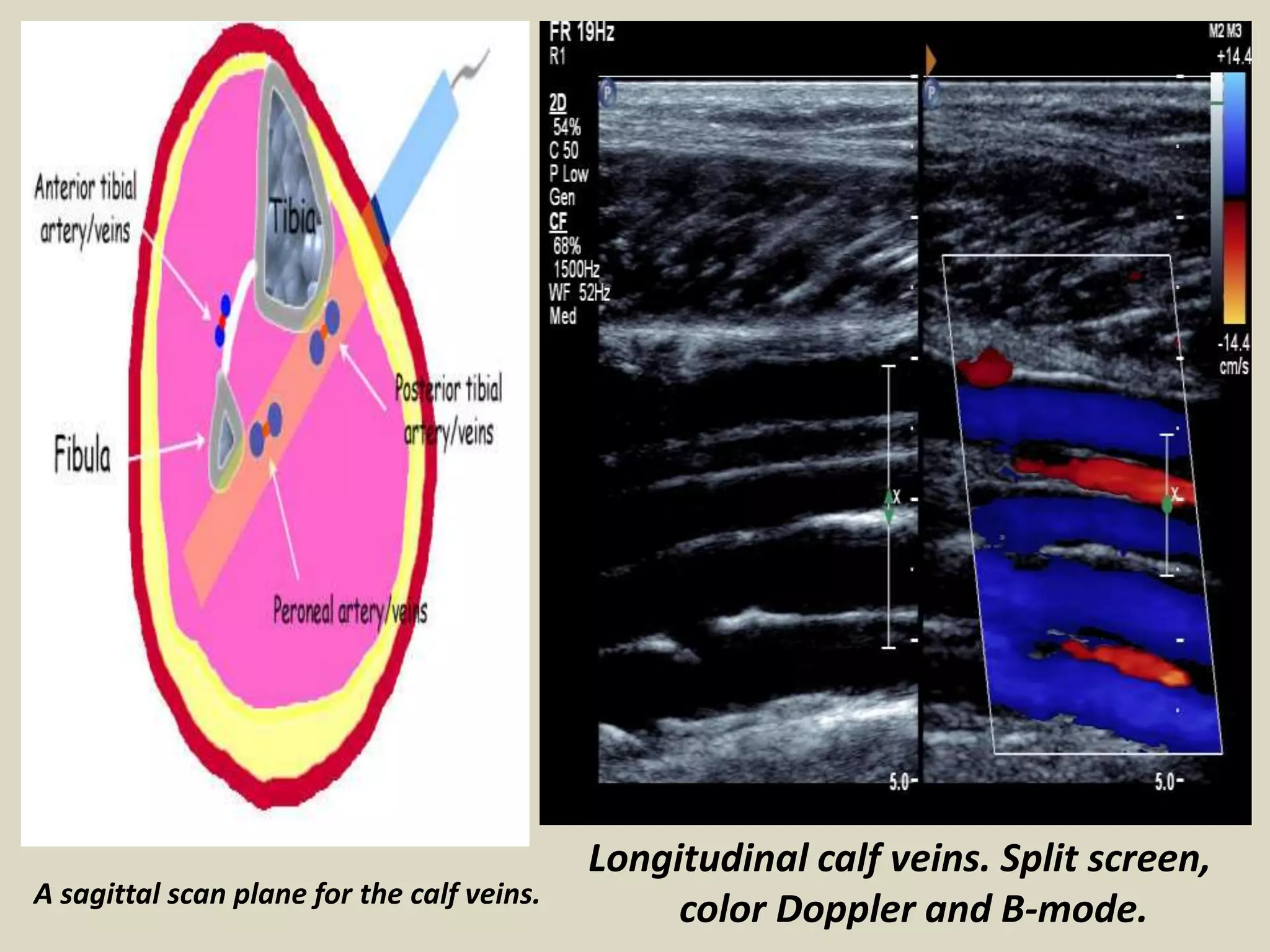 Presentation1.pptx, radiological vascular anatomy of the upper and ...