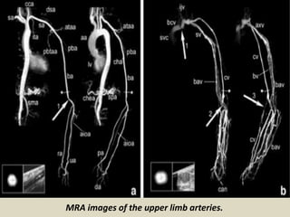 Presentation1.pptx, radiological vascular anatomy of the upper and ...