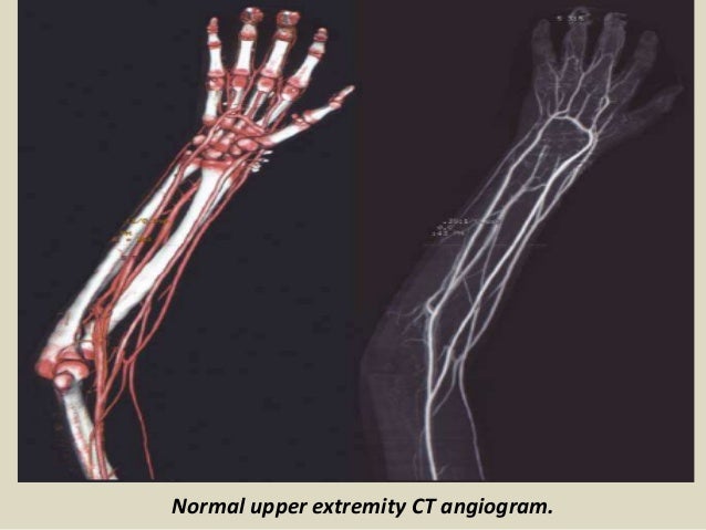 Upper Extremity Vascular Anatomy