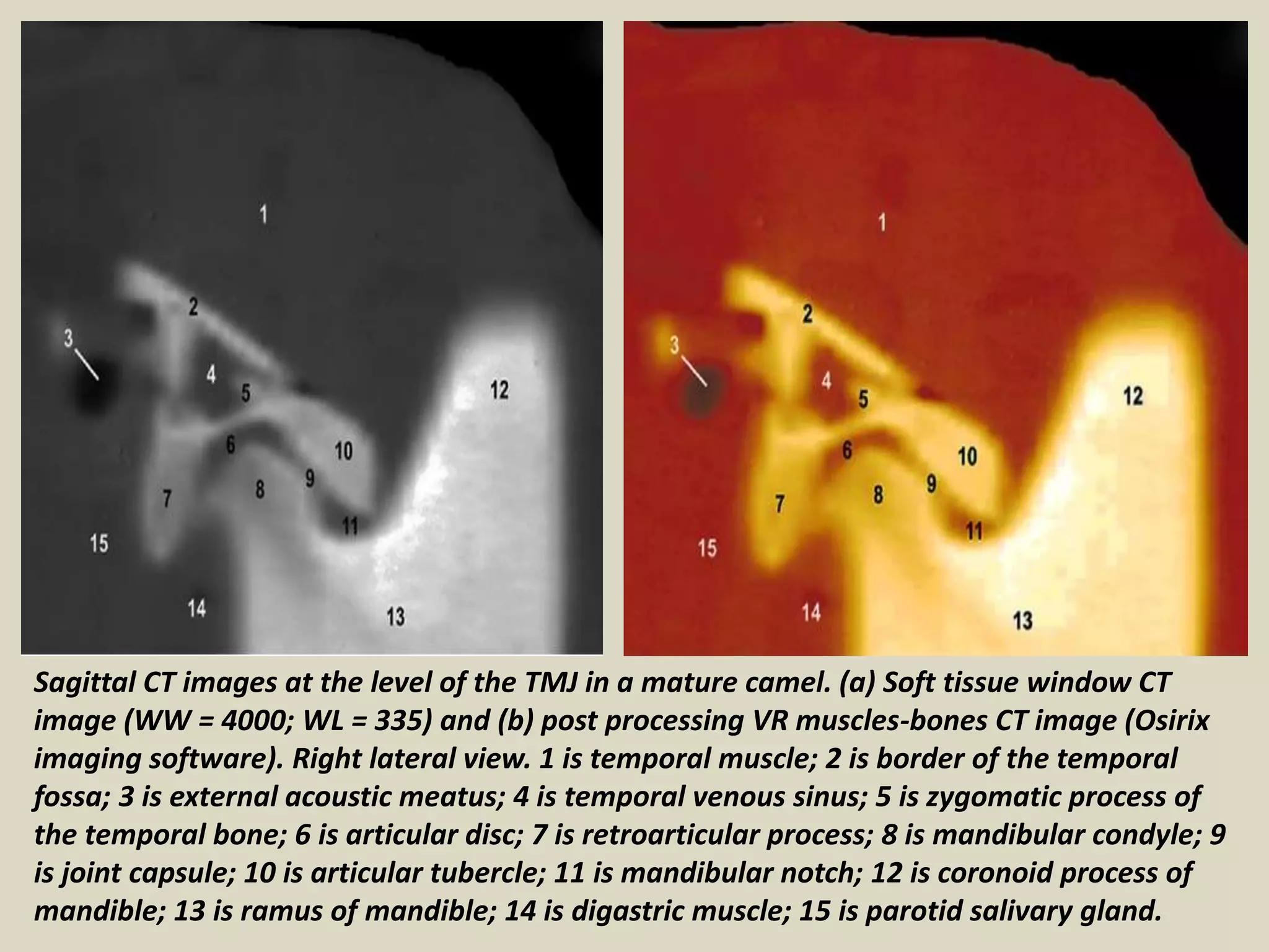Presentation1.pptx, radiological anatomy of the temporo mandibular ...