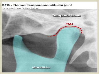 Presentation1.pptx, radiological anatomy of the temporo mandibular ...