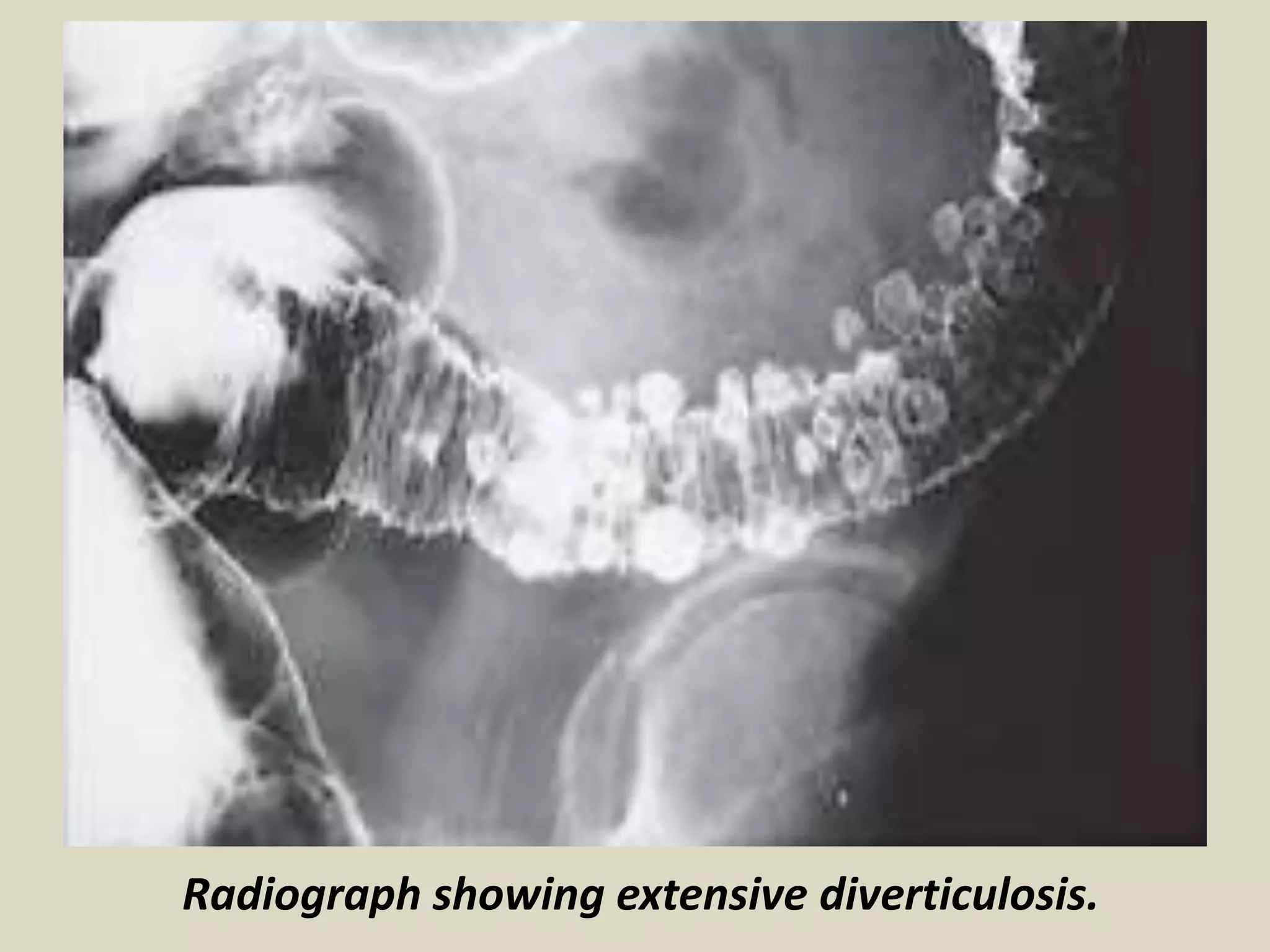 Presentation1.pptx, radiological imaging of divertiular disease and ...
