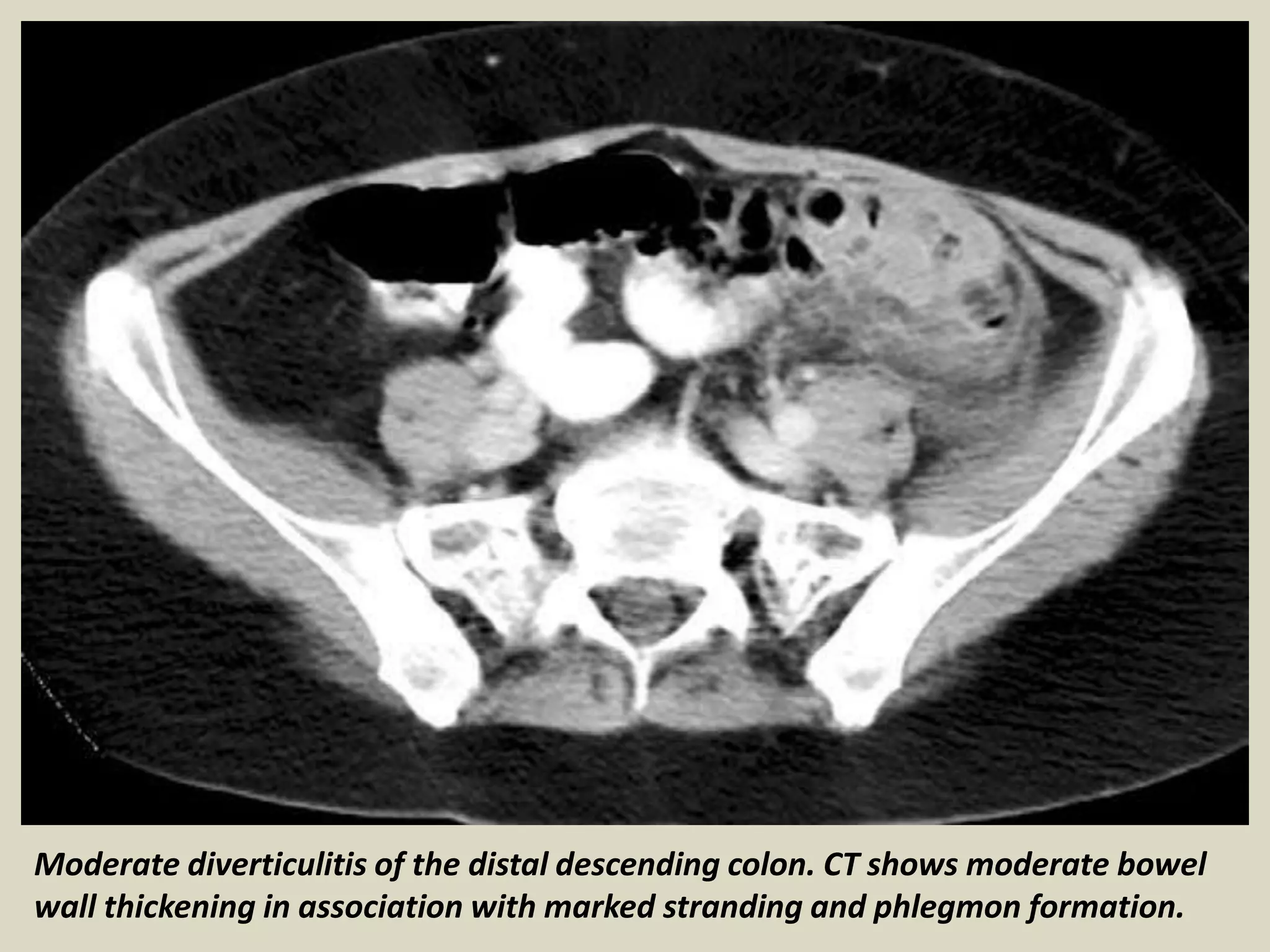 Presentation1.pptx, radiological imaging of divertiular disease and ...