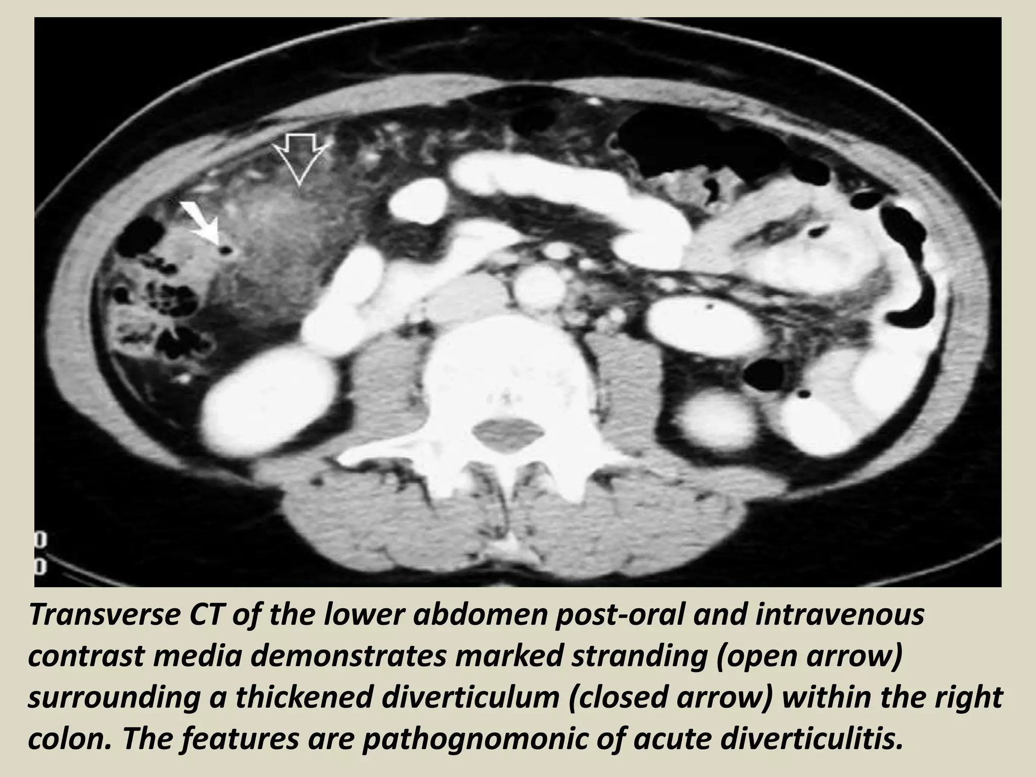 Presentation1.pptx, radiological imaging of divertiular disease and ...