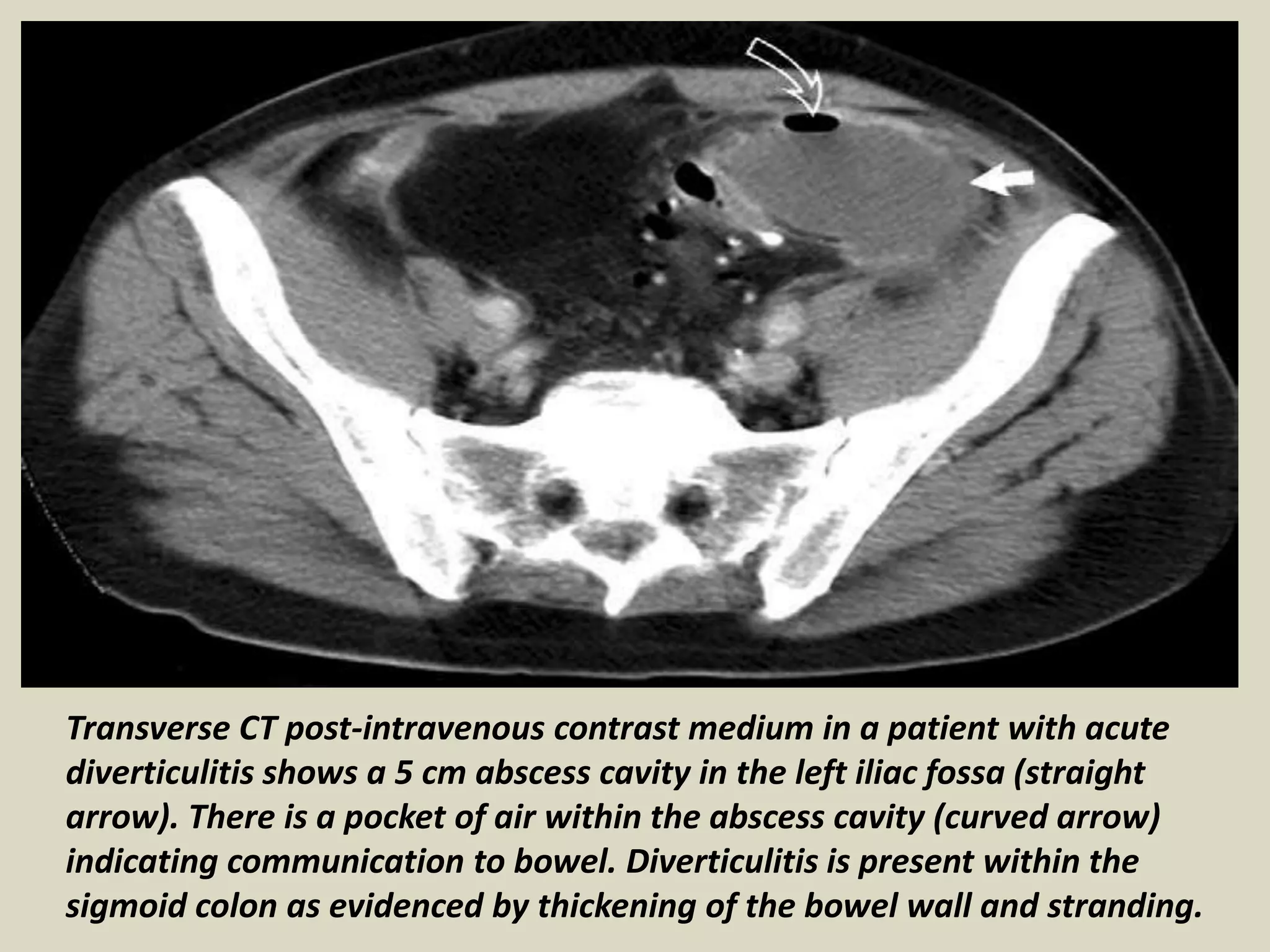 Presentation1.pptx, radiological imaging of divertiular disease and ...