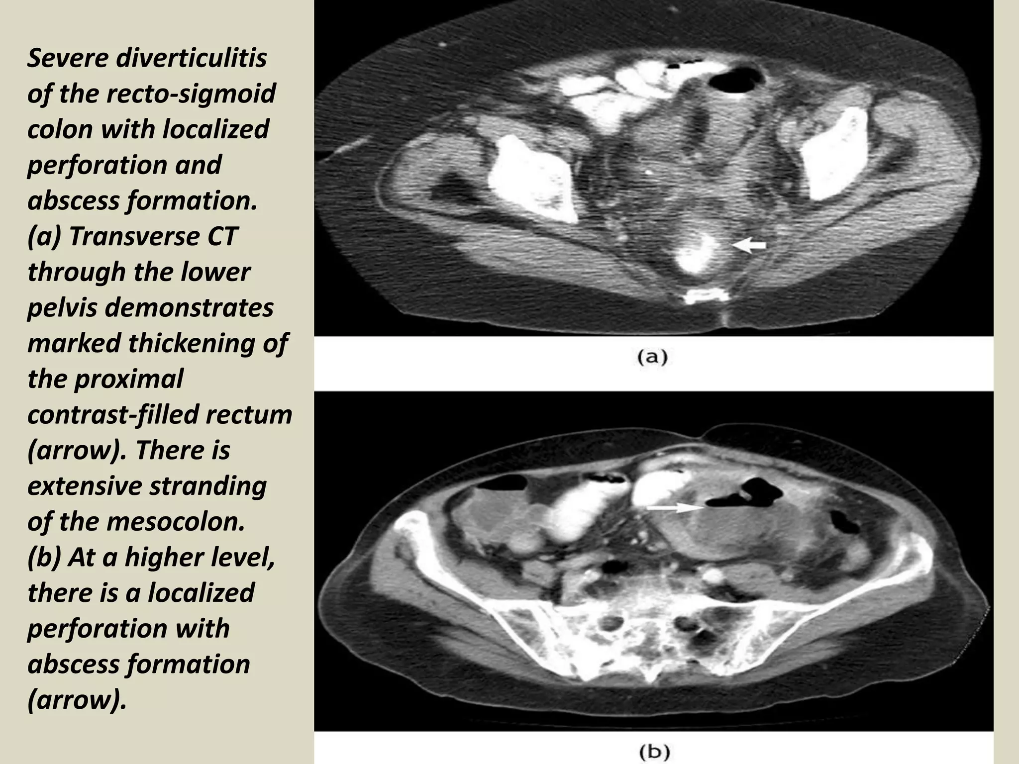 Presentation1.pptx, radiological imaging of divertiular disease and ...