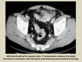 Presentation1.pptx, radiological imaging of divertiular disease and ...