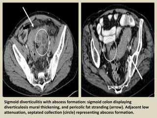 Presentation1.pptx, radiological imaging of divertiular disease and ...