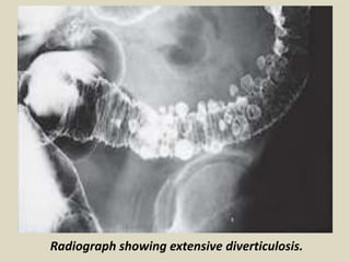 Diverticulosis X Ray