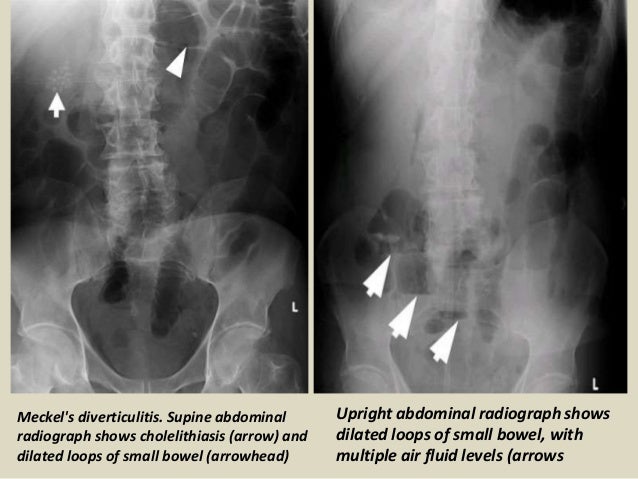 Presentation1.pptx, radiological imaging of divertiular disease and d…