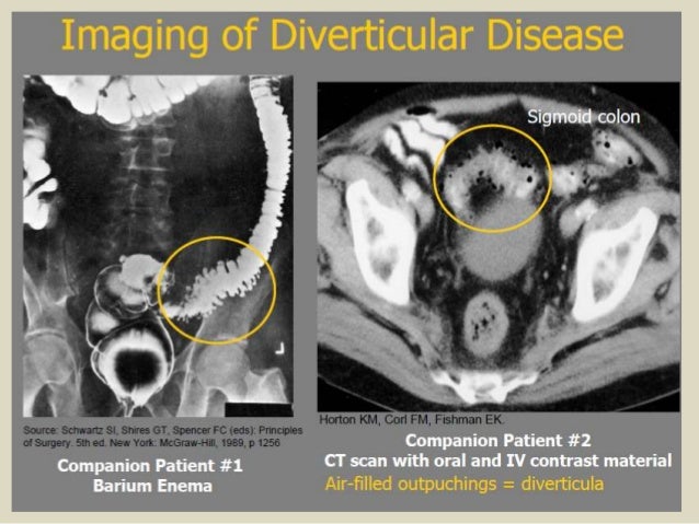 Presentation1.pptx, radiological imaging of divertiular disease and d…