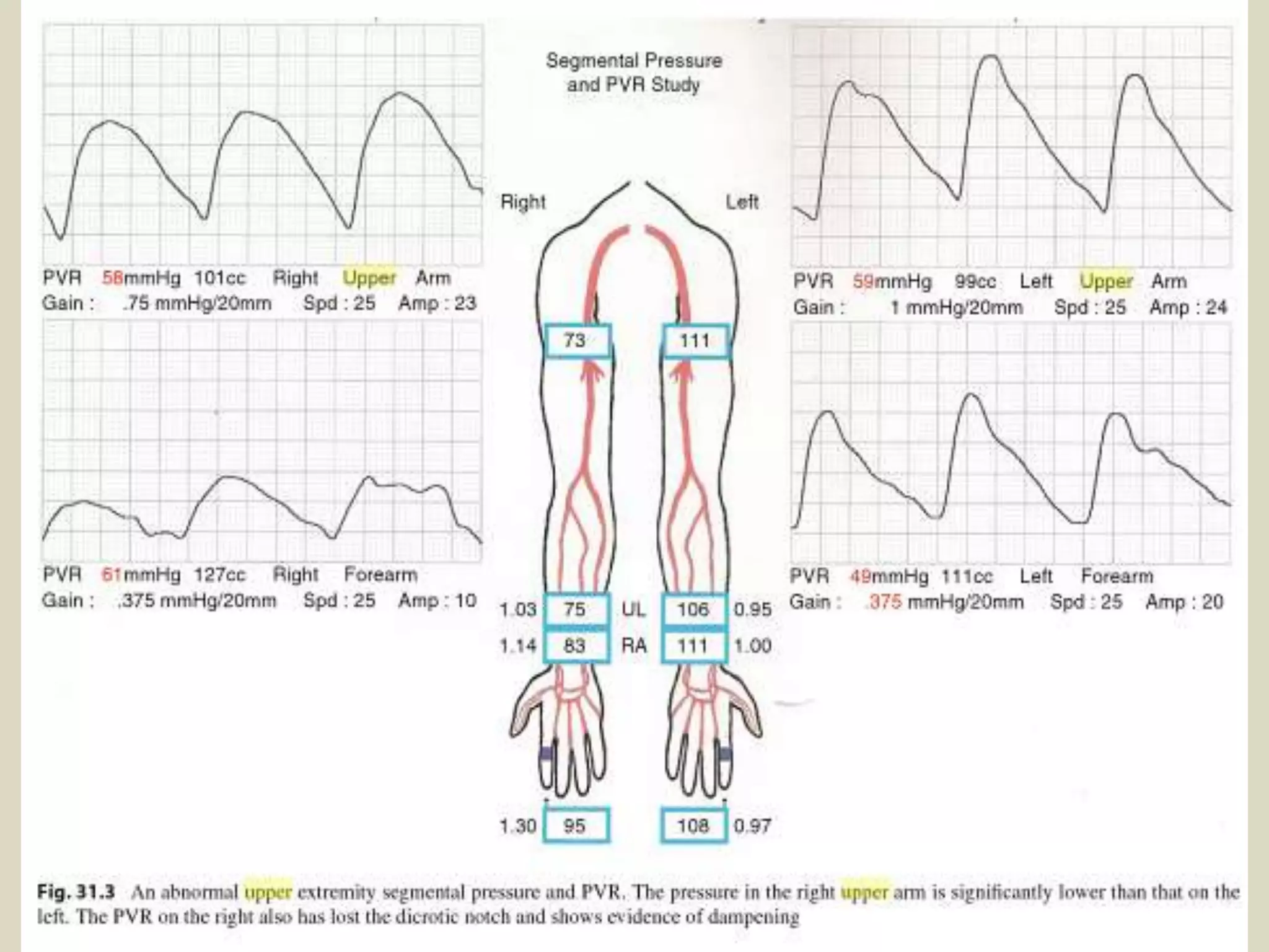 Presentation1.pptx, radiological imaging of upper limb ischemia. | PPT
