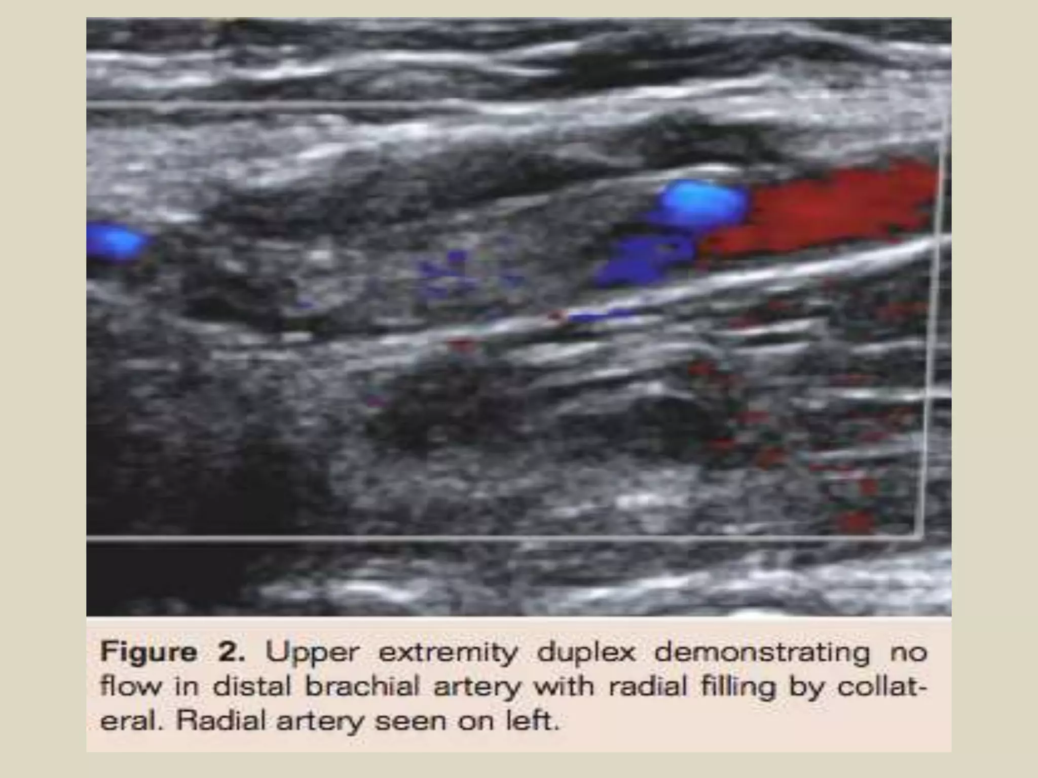 Presentation1.pptx, radiological imaging of upper limb ischemia. | PPTX
