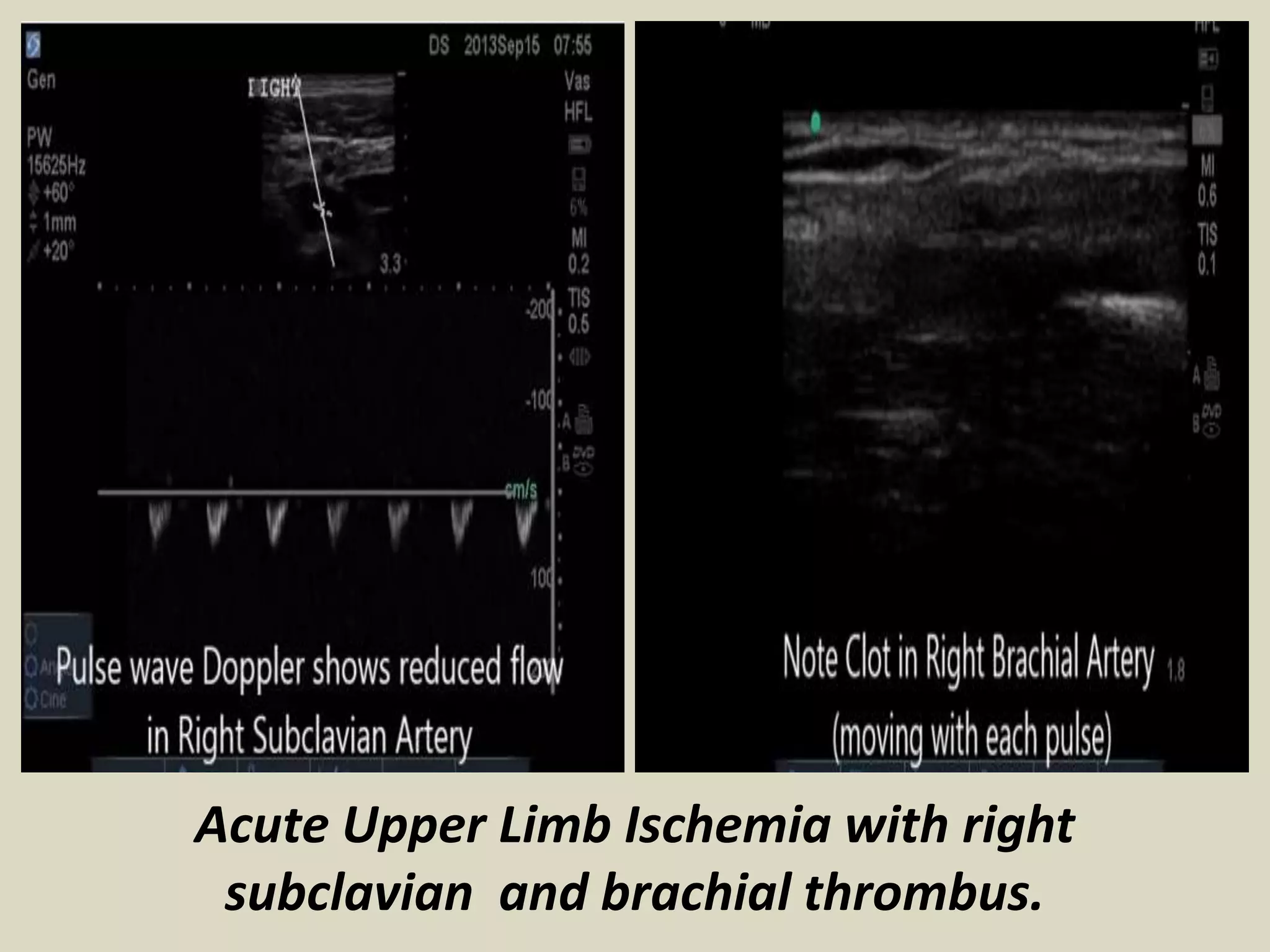 Presentation1.pptx, radiological imaging of upper limb ischemia. | PPTX