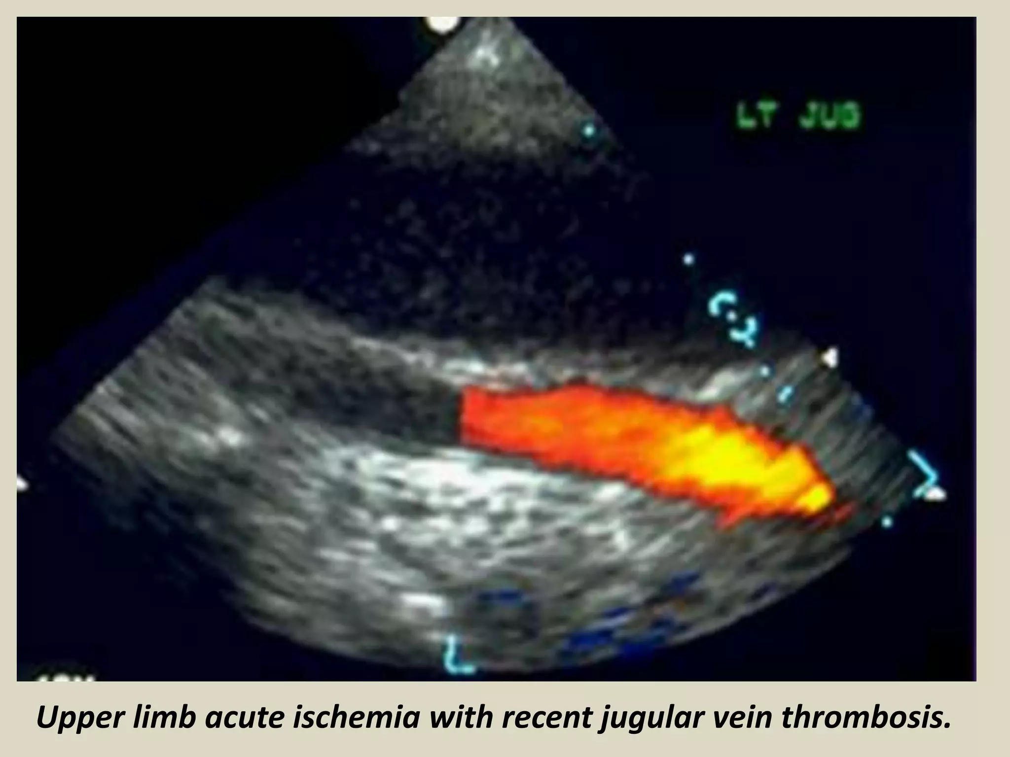 Presentation1.pptx, radiological imaging of upper limb ischemia. | PPTX