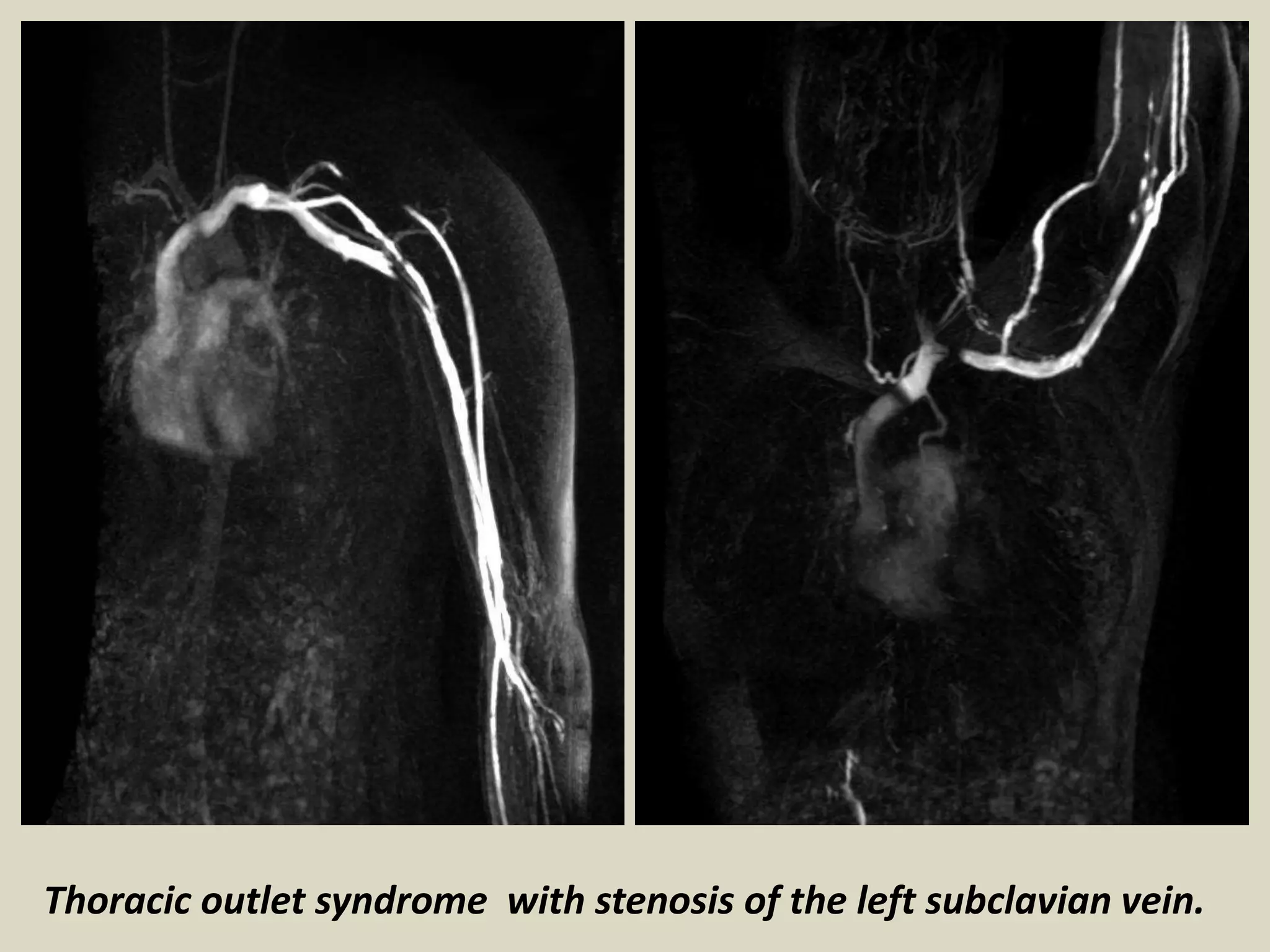 Presentation1.pptx, radiological imaging of upper limb ischemia. | PPTX