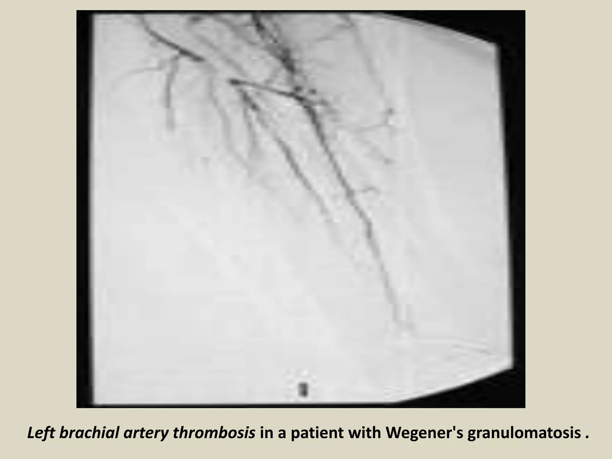 Presentation1.pptx, radiological imaging of upper limb ischemia. | PPTX