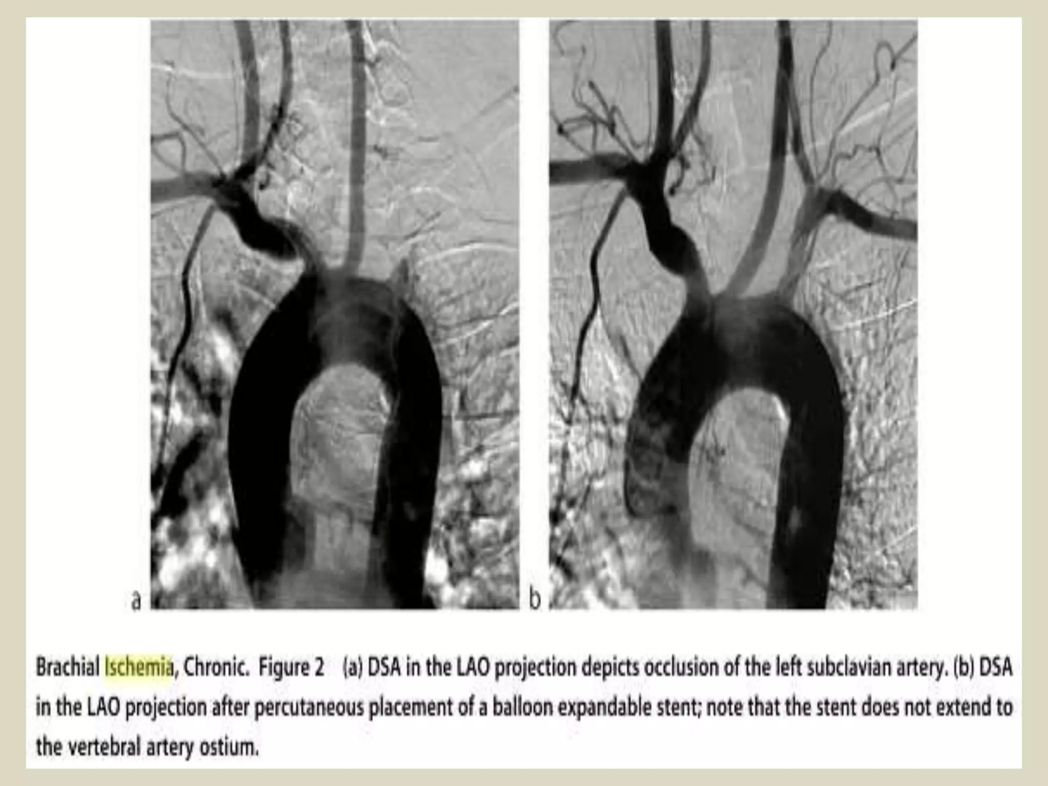 Presentation1.pptx, radiological imaging of upper limb ischemia. | PPTX