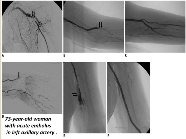 Presentation1.pptx, radiological imaging of upper limb ischemia. | PPTX