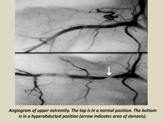 Presentation1.pptx, radiological imaging of upper limb ischemia. | PPTX