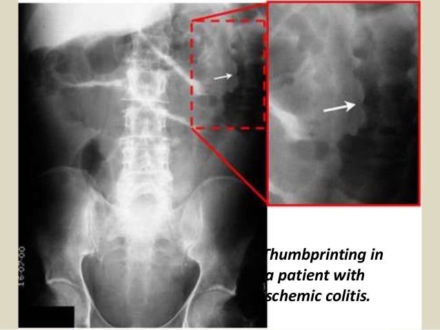 Presentation1.pptx, radiological imaging of mesenteric ischemia.