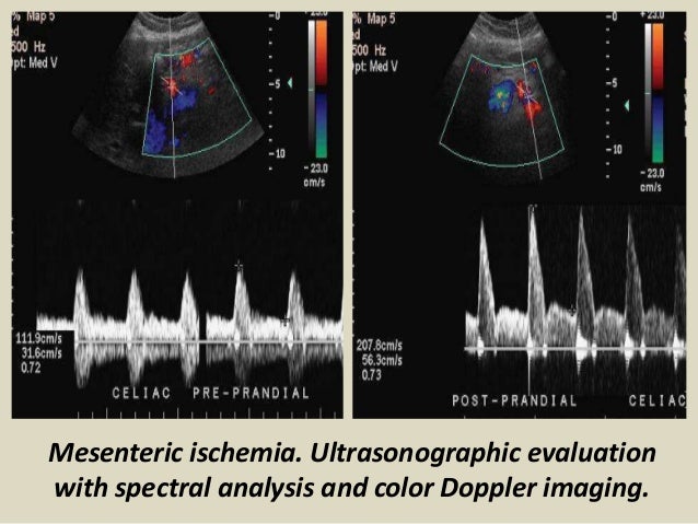 Presentation1.pptx, radiological imaging of mesenteric ischemia.