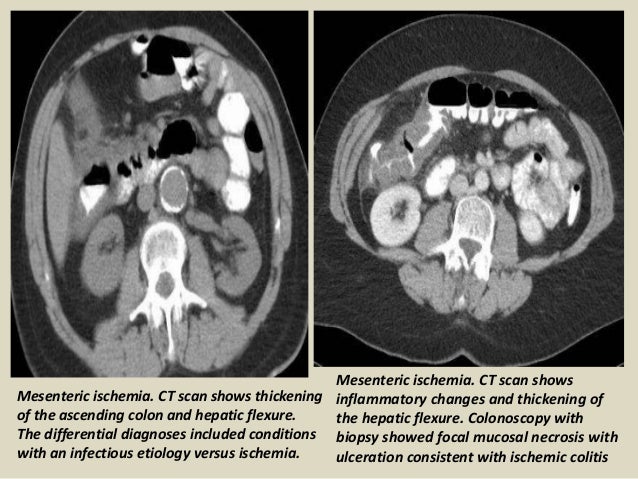 Presentation1.pptx, radiological imaging of mesenteric ischemia.