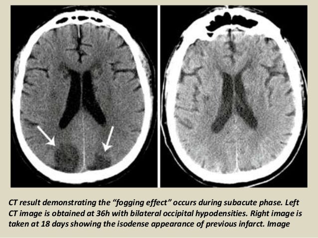 Presentation1.pptx, radiological imaging of cerebral ischemia.