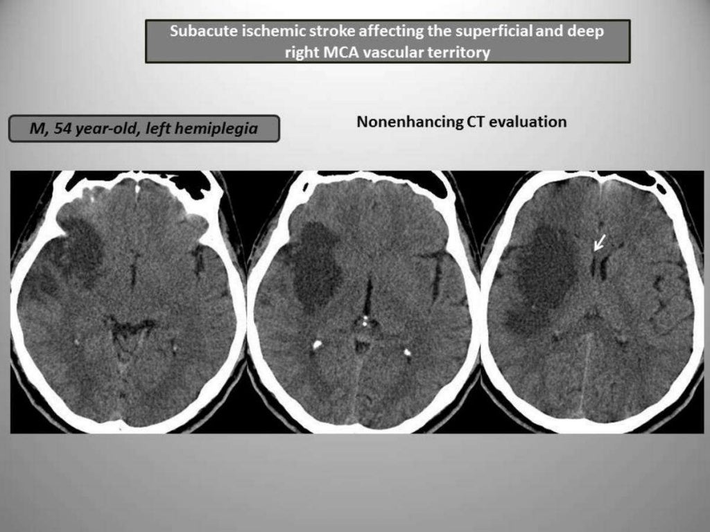 Presentation1.pptx, radiological imaging of cerebral ischemia.