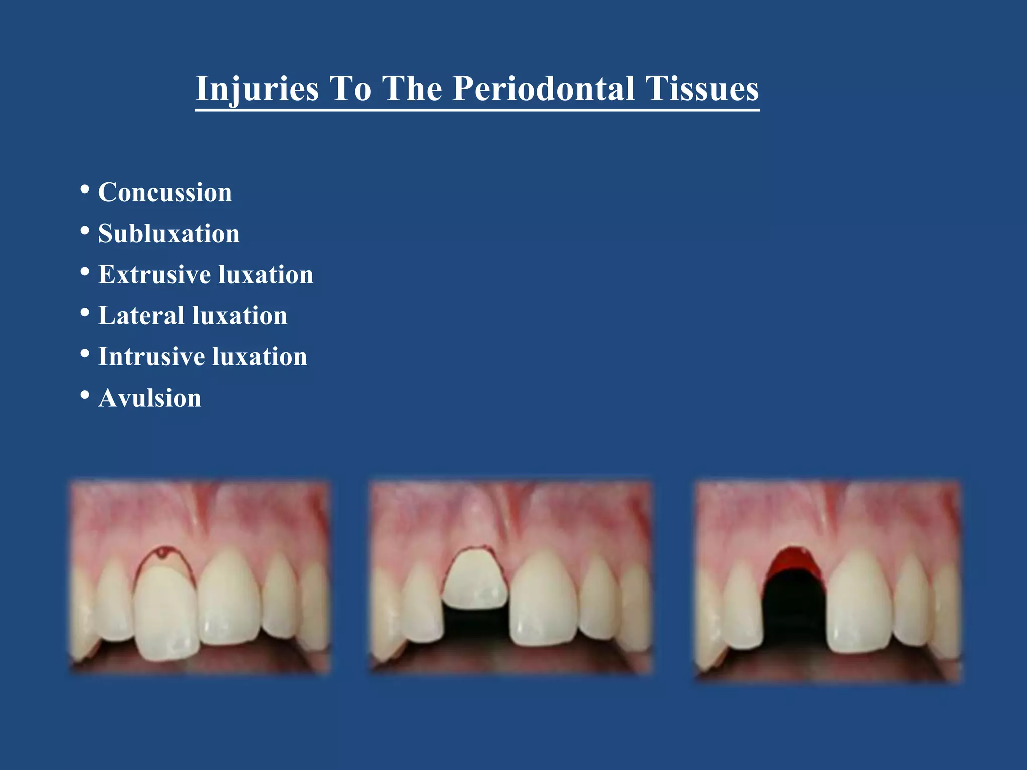 Trauma To Primary Teeth | PPTX