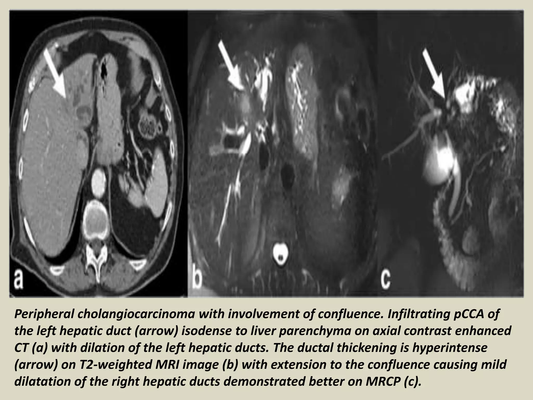 Presentation1.pptx, radiological imaging of cholangiocarcinoma. | PPTX