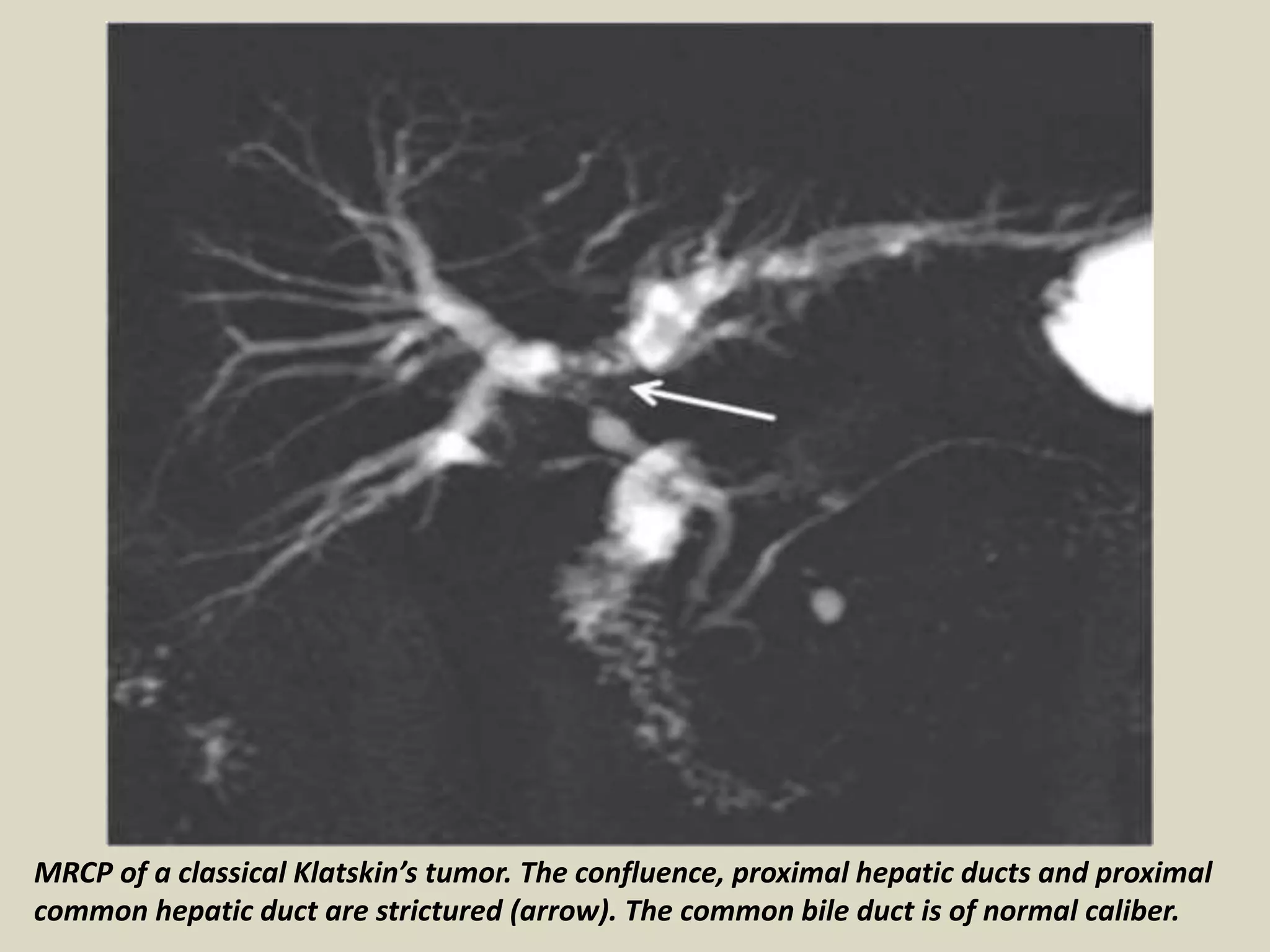 Presentation1.pptx, radiological imaging of cholangiocarcinoma. | PPTX