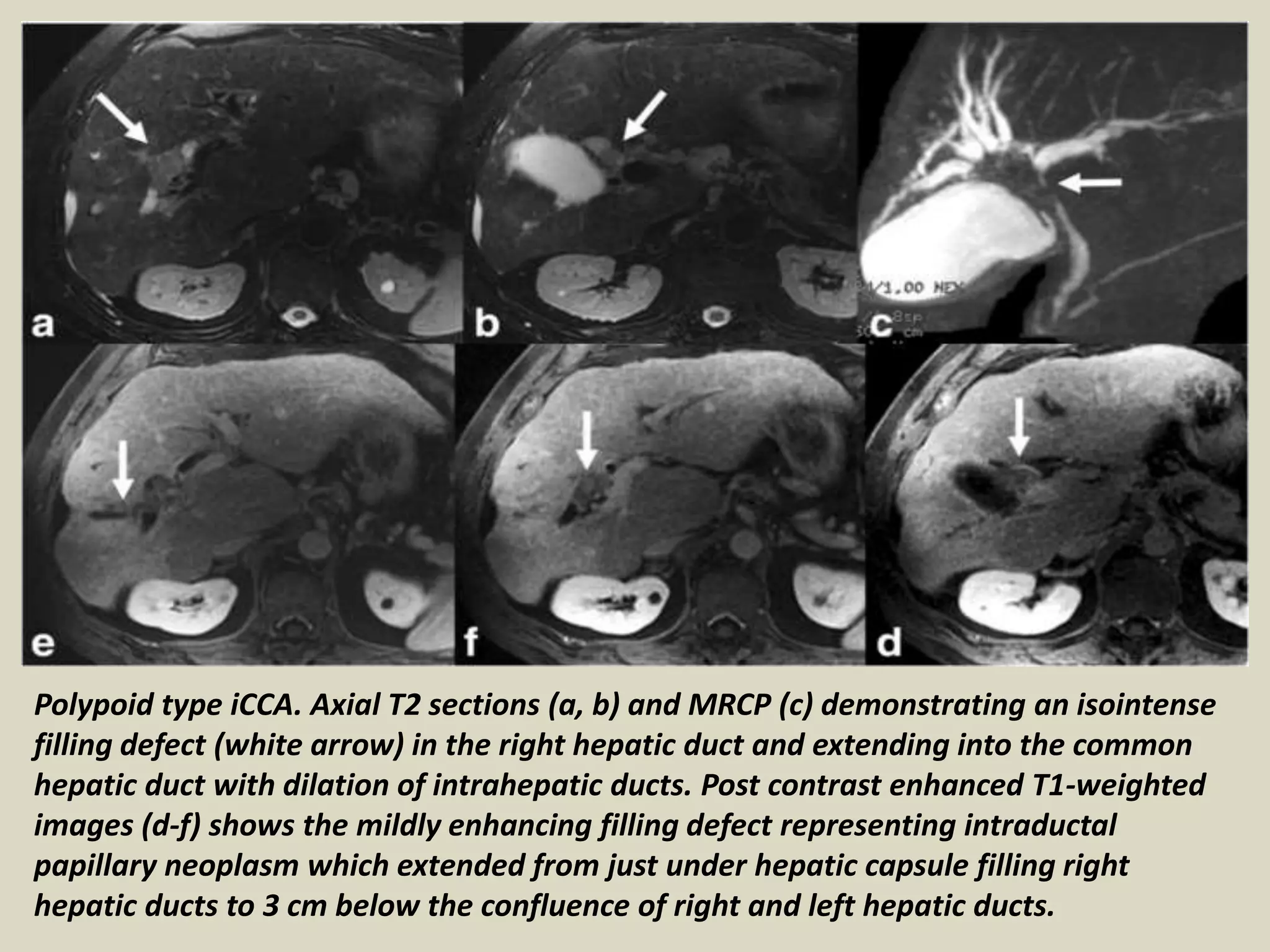 Presentation1.pptx, radiological imaging of cholangiocarcinoma. | PPTX