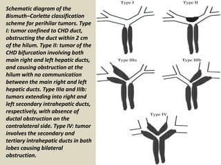 Presentation1.pptx, radiological imaging of cholangiocarcinoma. | PPTX