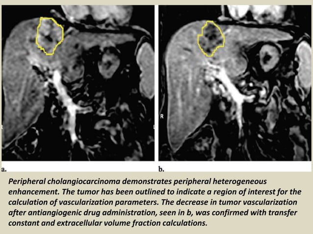 Presentation1.pptx, radiological imaging of cholangiocarcinoma. | PPTX
