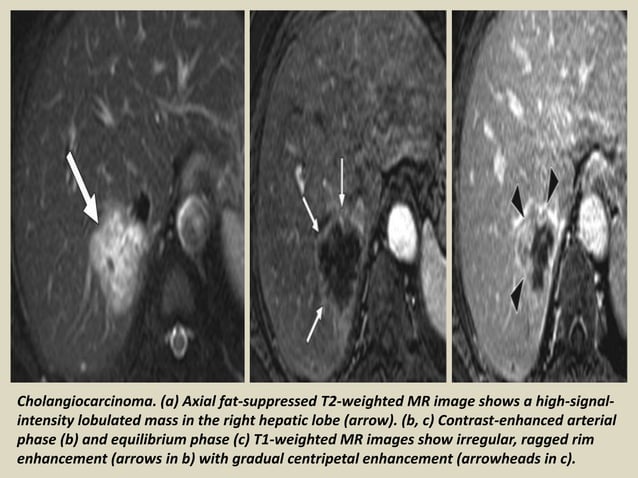 Presentation1.pptx, radiological imaging of cholangiocarcinoma. | PPTX