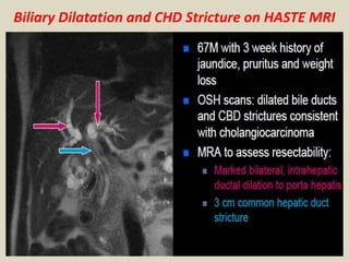 Presentation1.pptx, radiological imaging of cholangiocarcinoma. | PPTX