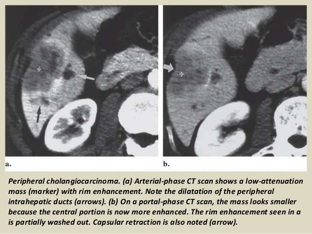 Cholangiocarcinoma Radiopaedia
