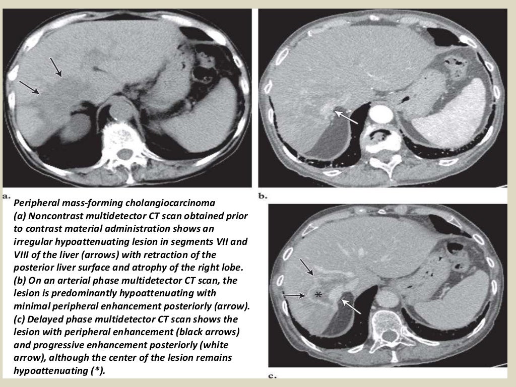 Cholangiocarcinoma Radiology