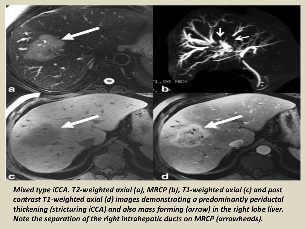 Cholangiocarcinoma Radiology