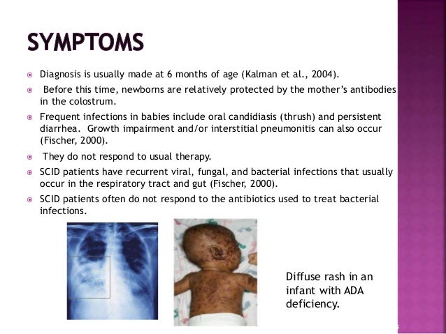 Adenosine deaminase (ADA) immunodeficiency