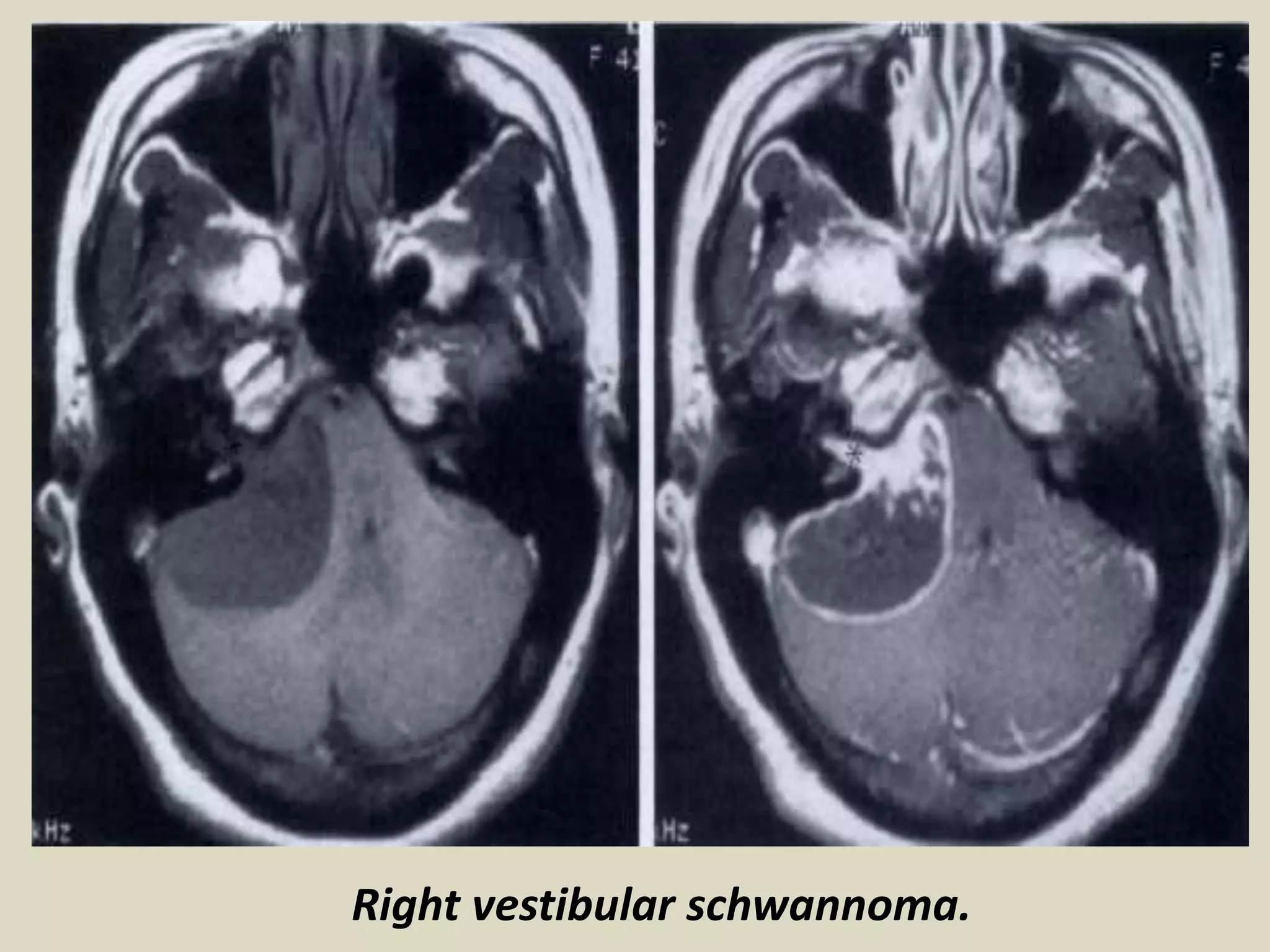 Presentation1.pptx, radiological imaging of cerebello pontine angle ...