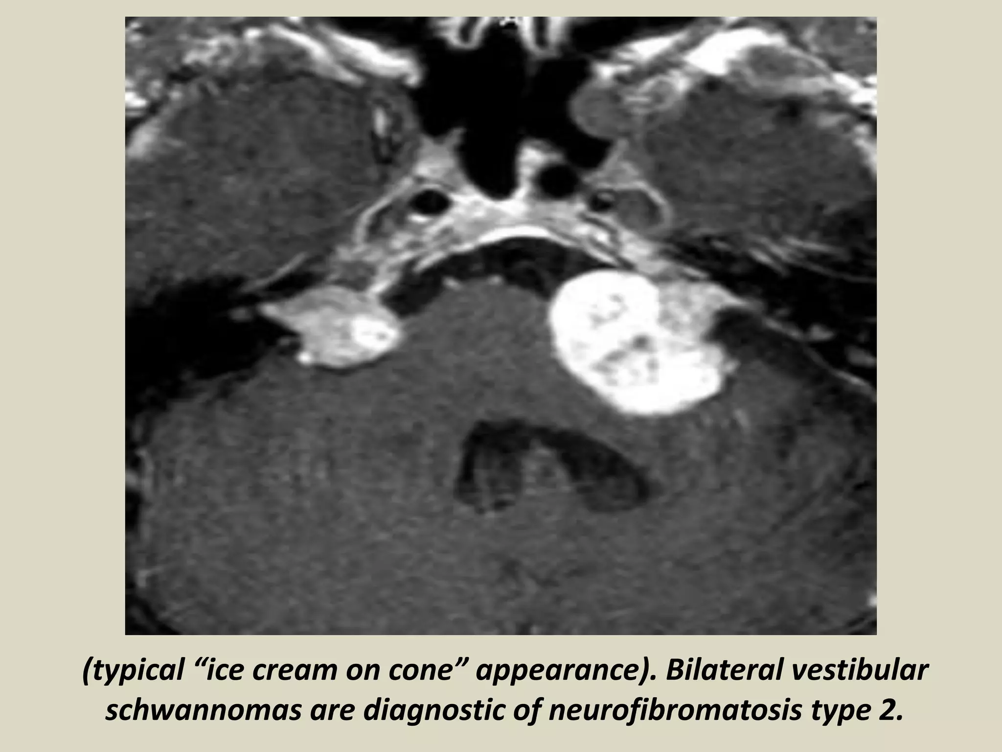 Presentation1.pptx, radiological imaging of cerebello pontine angle ...