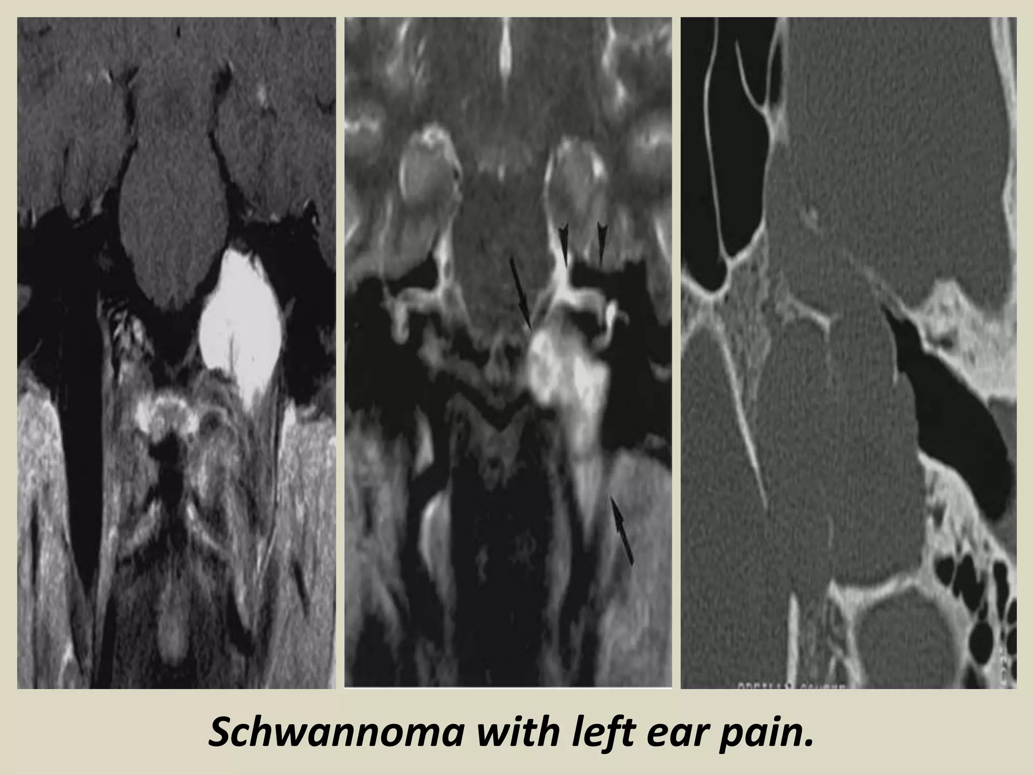 Presentation1.pptx, radiological imaging of cerebello pontine angle ...