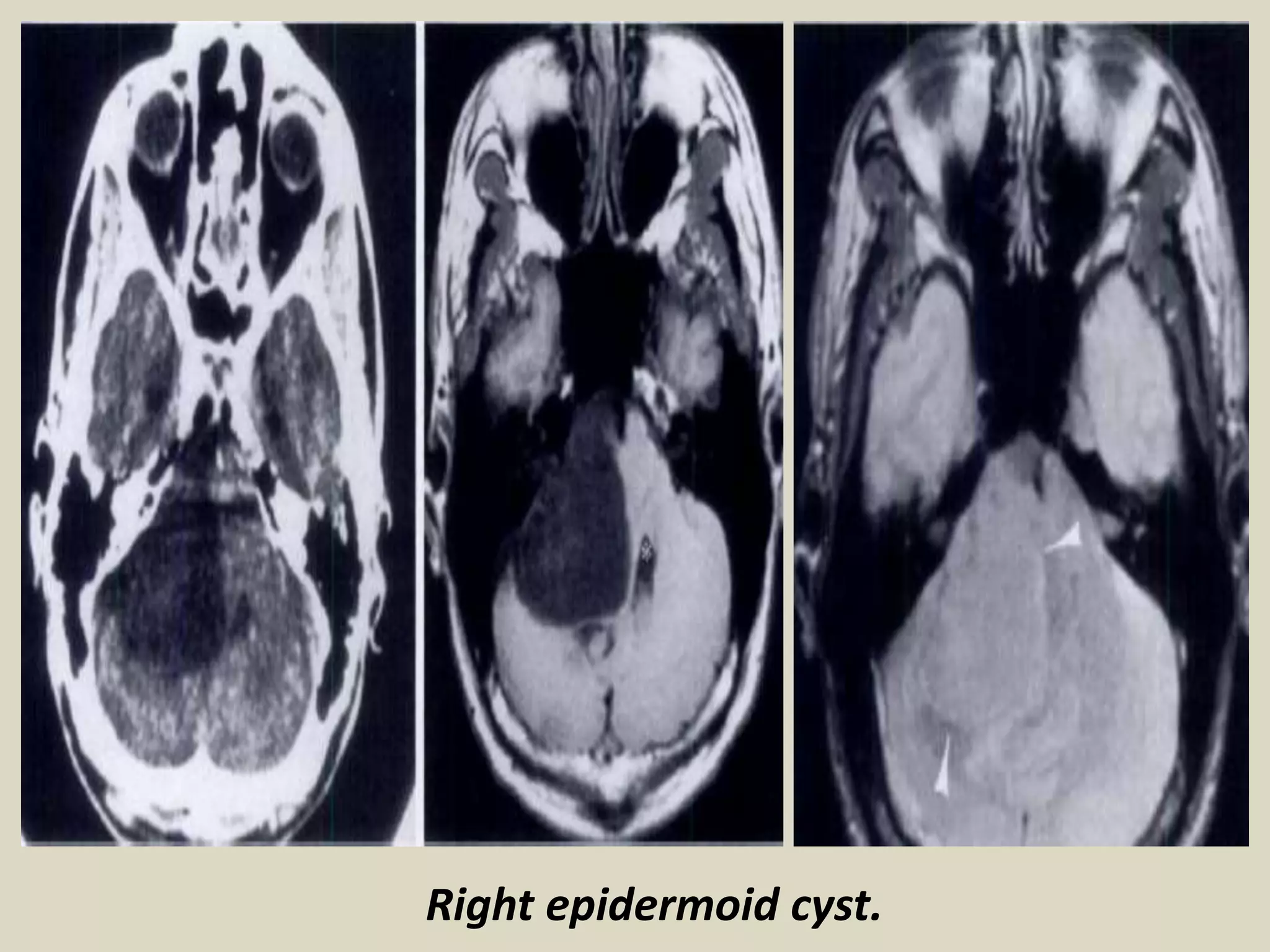 Presentation1.pptx, radiological imaging of cerebello pontine angle ...